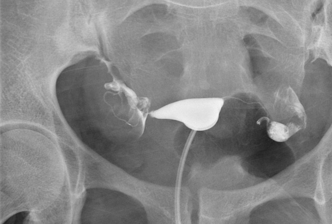 Fertility & Infertility - Advanced Women's Healthcare: Dallas OBGYN